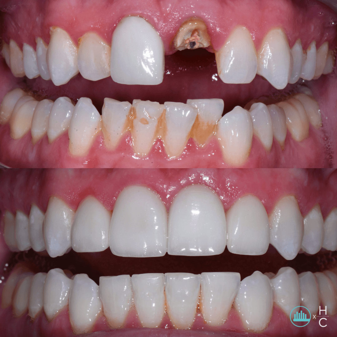 Can A Dead Tooth Be Saved l Chicago Dental Studio