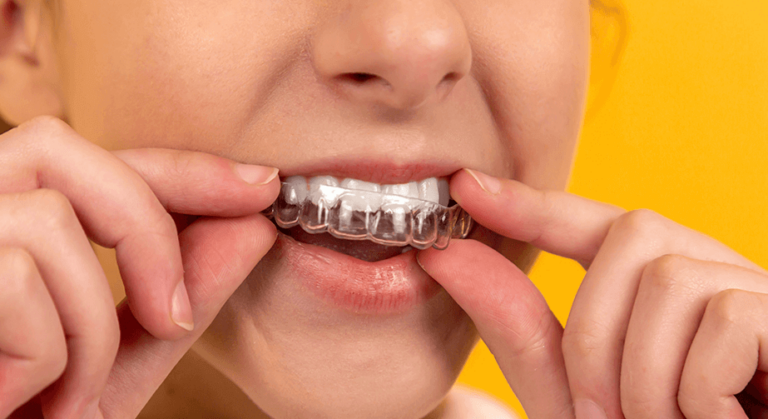 How Long Does Invisalign Take | Invisalign Treatment Time | CDS