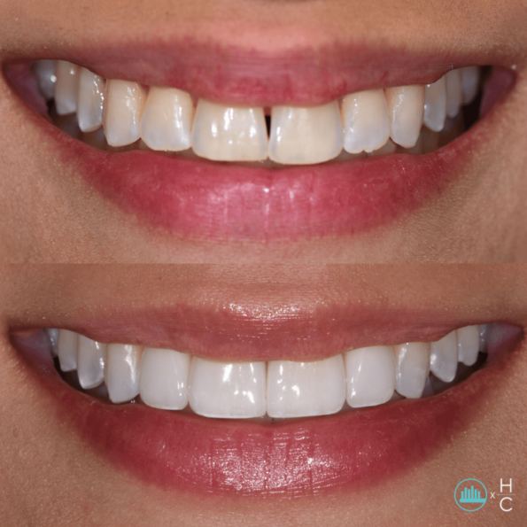 What Are Veneers | Definition, Define Process, Pros And Cons - CDS