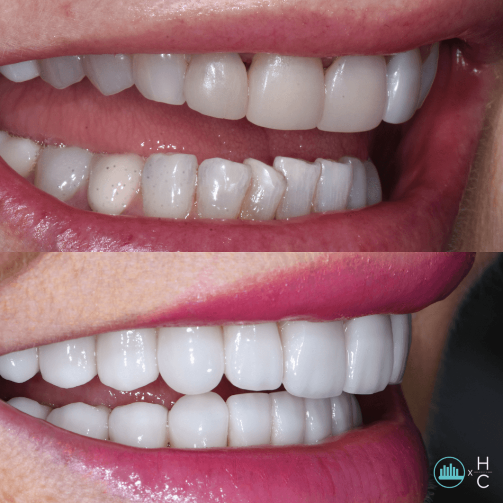 Gingivectomy: Gingivitis Surgery Procedure, Gum Contouring Recovery