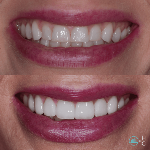 Gingivectomy: Gingivitis Surgery Procedure, Gum Contouring Recovery