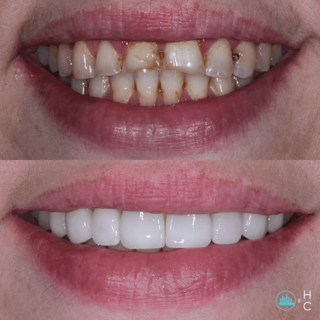 Dental Reconstruction | What Is Full Mouth Restoration Dentistry