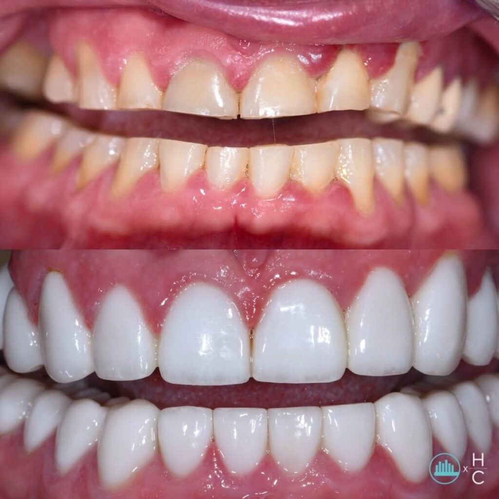 How to Fix An Overbite: Treatment & Correction - The Chicago Dental Studio