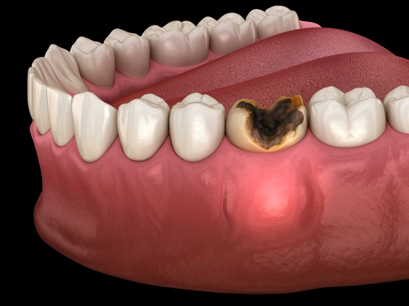 Rotten Teeth From Soda